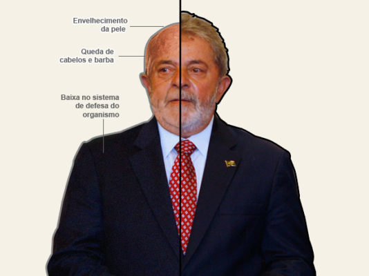 Saiba como identificar o câncer de laringe, a doença que atingiu Lula ...
